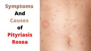 Pityriasis Rosea Foods To Avoid? Its Symptoms And Causes