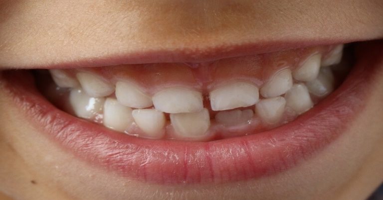 When Their Child Lose First Baby Teeth - A Complete Guide